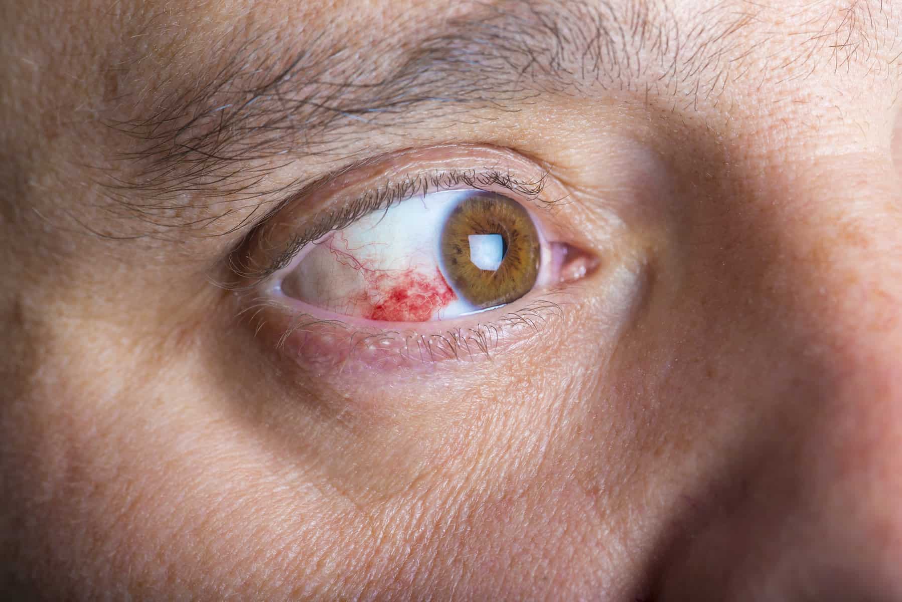 Pink Eye | Understanding the Causes, Symptoms, and Treatment