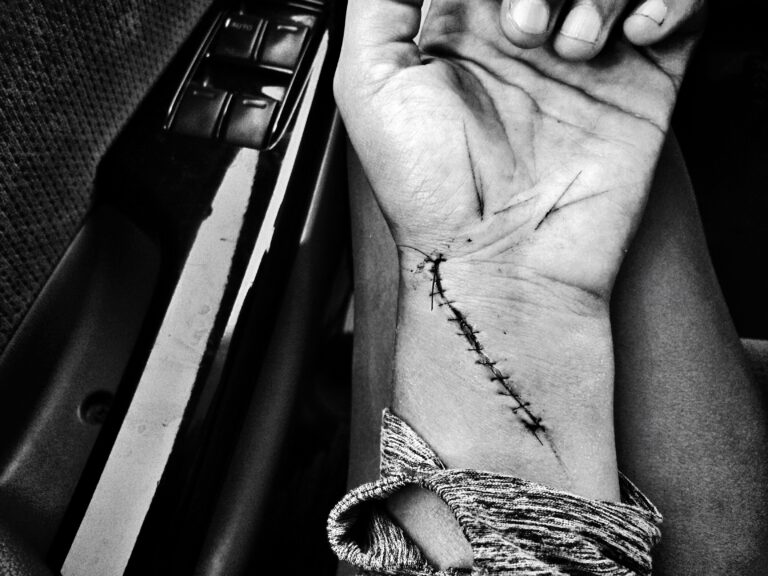 Stitches: What to Do & When to Get Them For Deep Cut Treatment